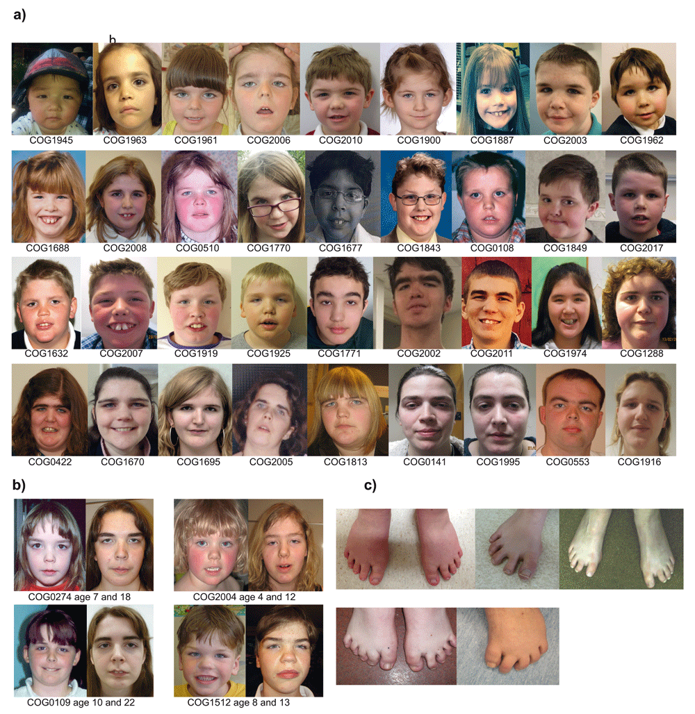 The Tatton-Brown-Rahman Syndrome: A... | Wellcome Open Research