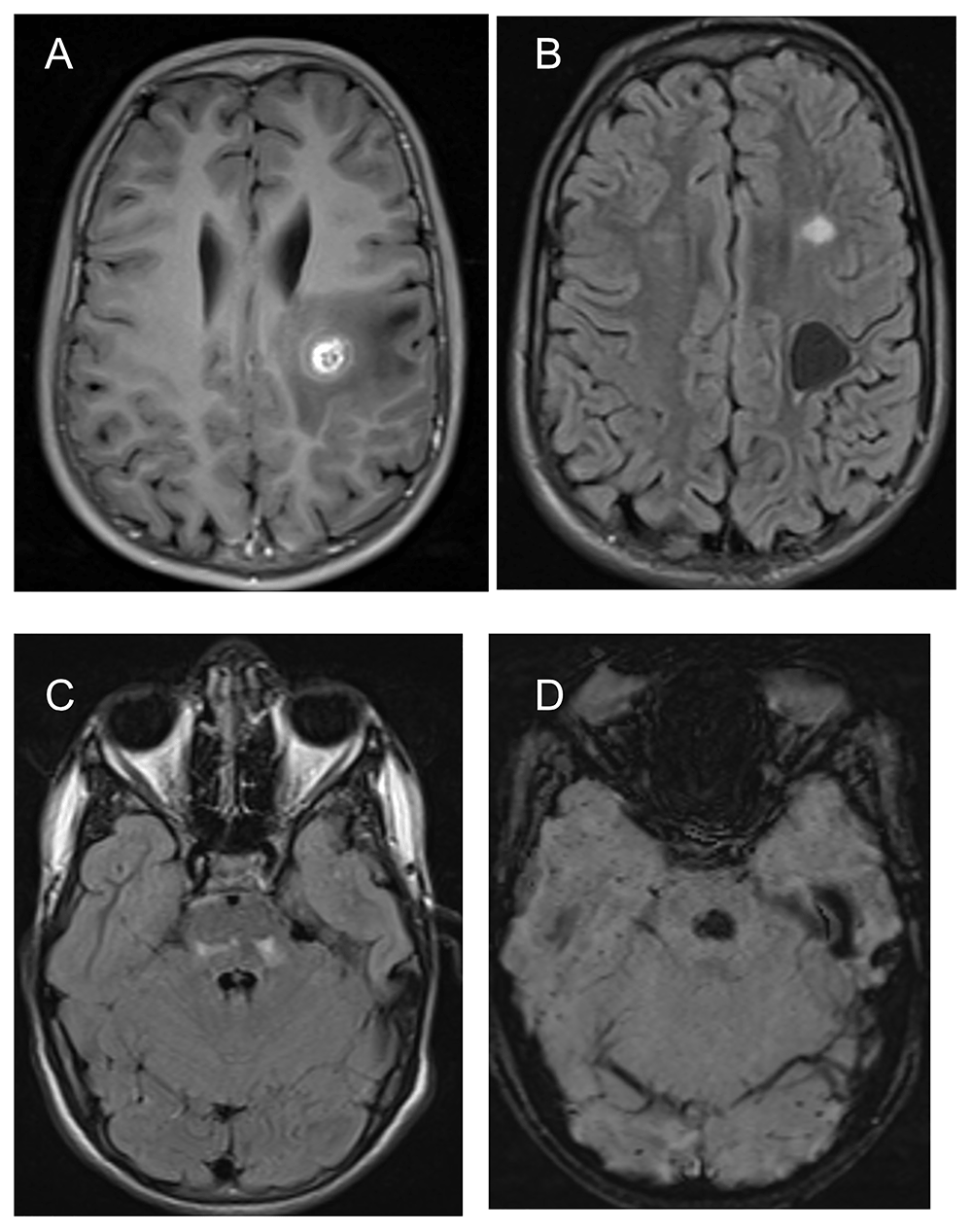 Case Report: Novel neuroinflammatory... | Wellcome Open Research